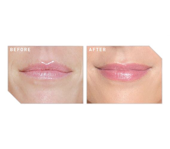 Antes y después del lifting facial líquido: Cómo redefinir tu look