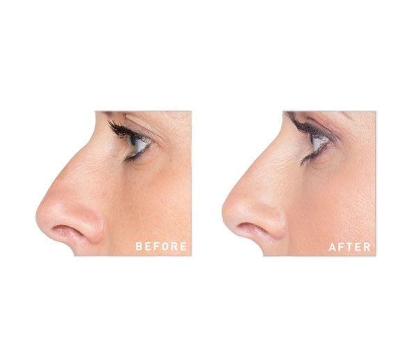 Antes y después del lifting facial líquido: Cómo redefinir tu look
