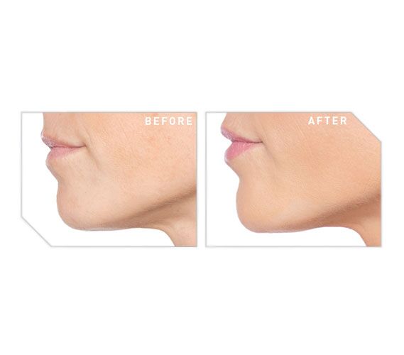 Antes y después del lifting facial líquido: Cómo redefinir tu look