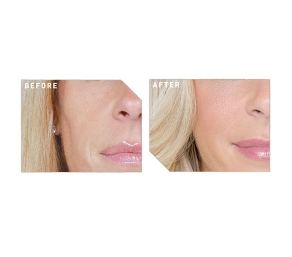 Antes y después del lifting facial líquido: Cómo redefinir tu look