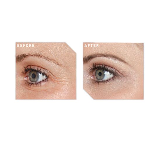 Antes y después del lifting facial líquido: Cómo redefinir tu look