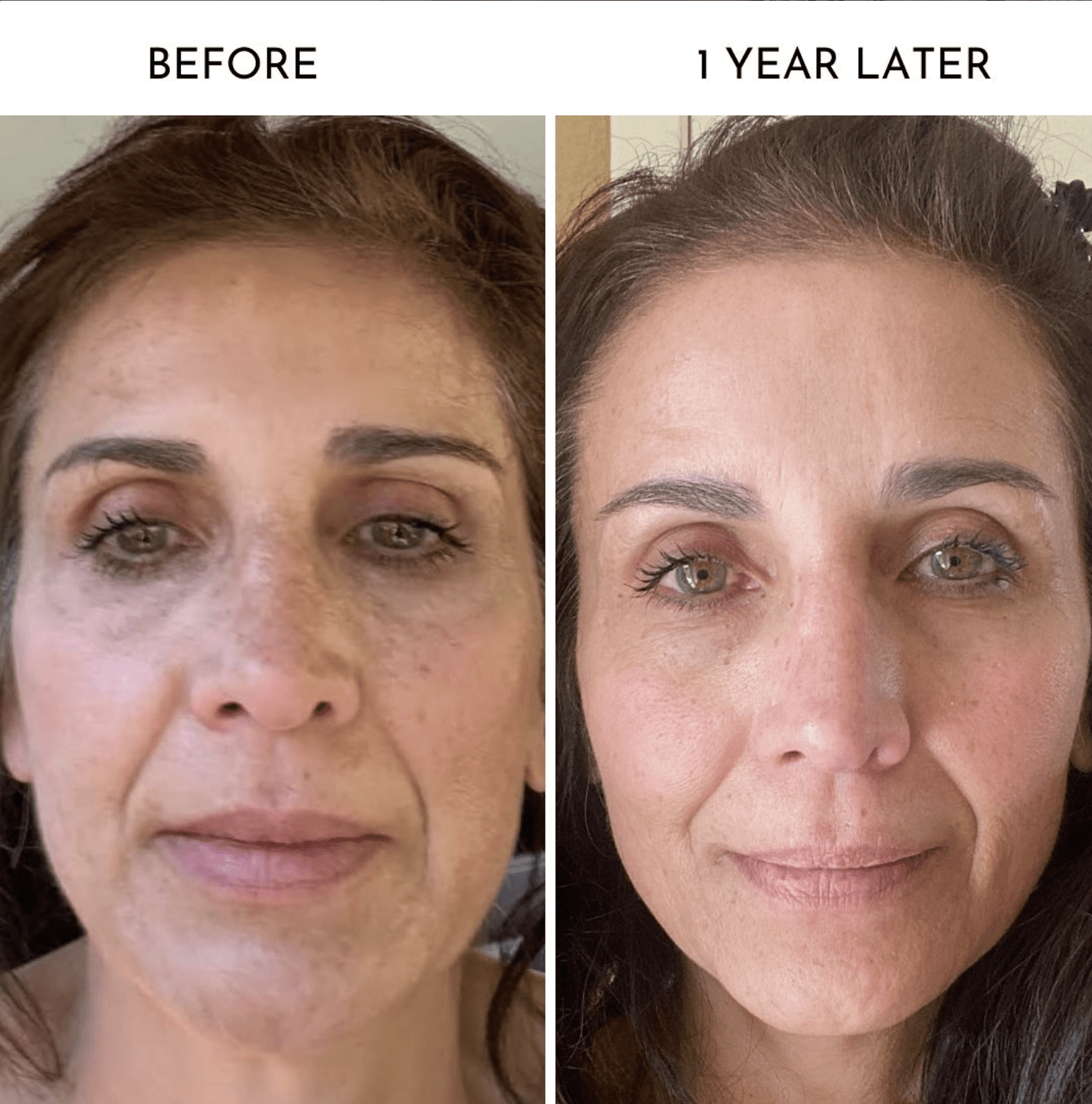 Microneedling Antes y Después: La transformación definitiva