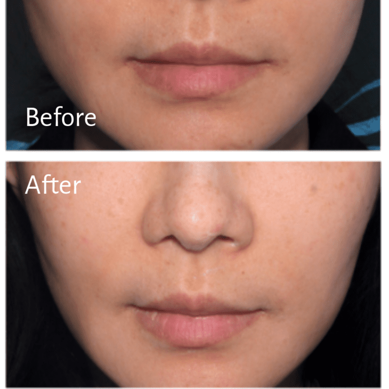 Así le afinó el rostro a estas pacientes el Botox en la mandíbula