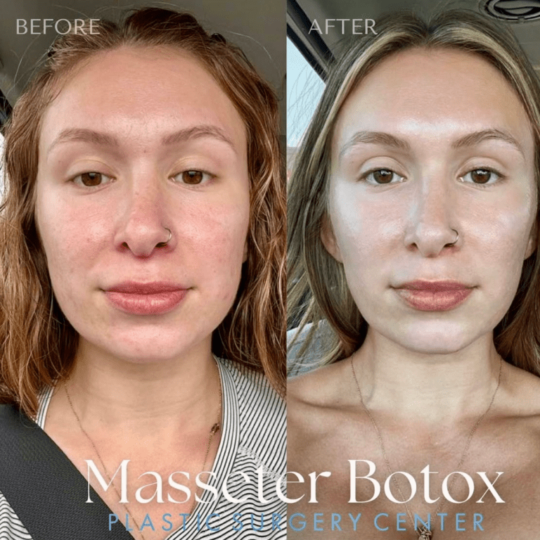 Así le afinó el rostro a estas pacientes el Botox en la mandíbula