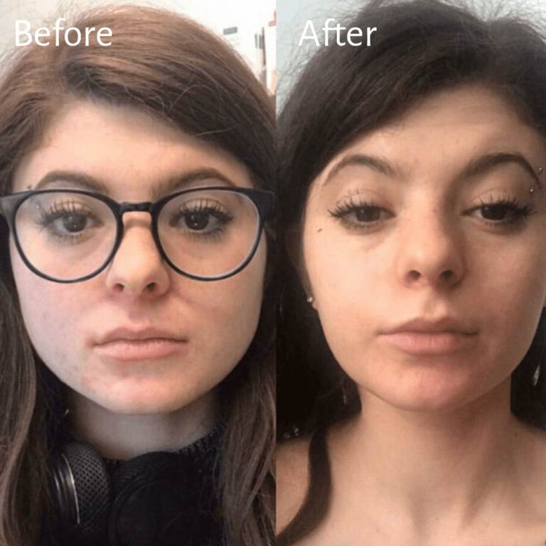 Así le afinó el rostro a estas pacientes el Botox en la mandíbula