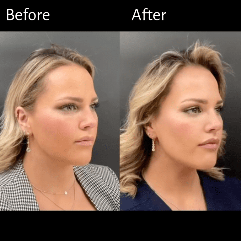 Así le afinó el rostro a estas pacientes el Botox en la mandíbula