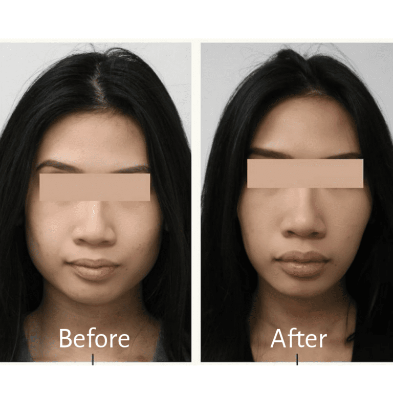 Así le afinó el rostro a estas pacientes el Botox en la mandíbula
